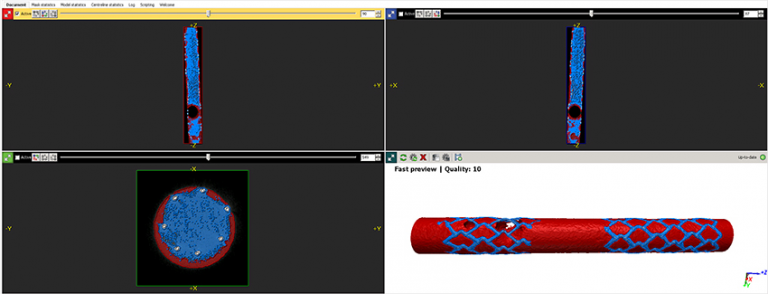 分析冠状动脉支架血栓形成【Simpleware应用】 – 费米科技